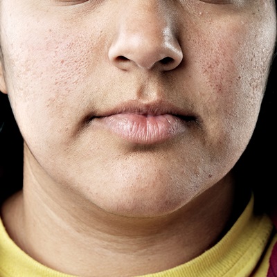 DMK Skin Treatments Page 2 | DMK Skincare